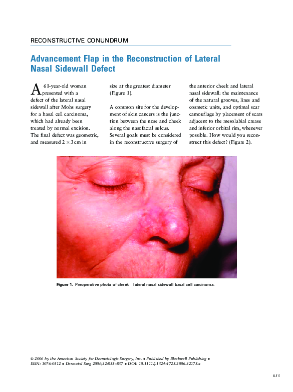 (PDF) Advancement Flap in the Reconstruction of Lateral Nasal Sidewall ...