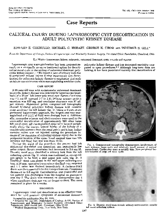 (PDF) Caliceal Injury in Laparoscopic Cyst Surgery