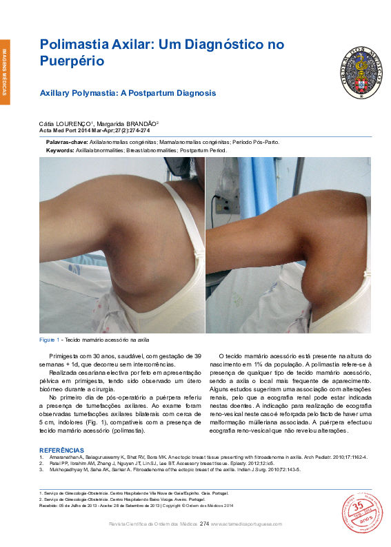 (PDF) Polimastia Axilar: Um Diagnóstico no Puerpério