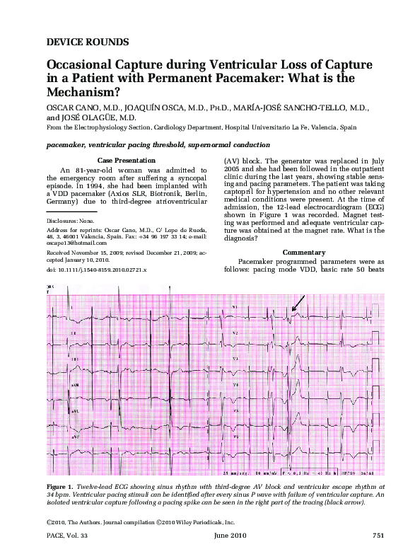 (PDF) Occasional Capture during Ventricular Loss of Capture in a ...