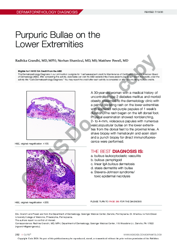 (PDF) Purpuric Bullae on the Lower Extremities | Radhika Grandhi ...