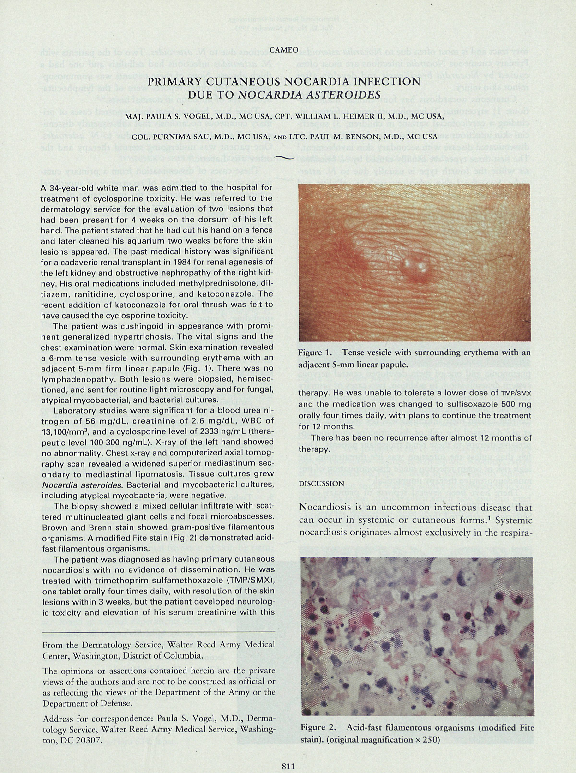 (PDF) Primary Cutaneous Nocardia Infection Due to Nocardia Asteroides