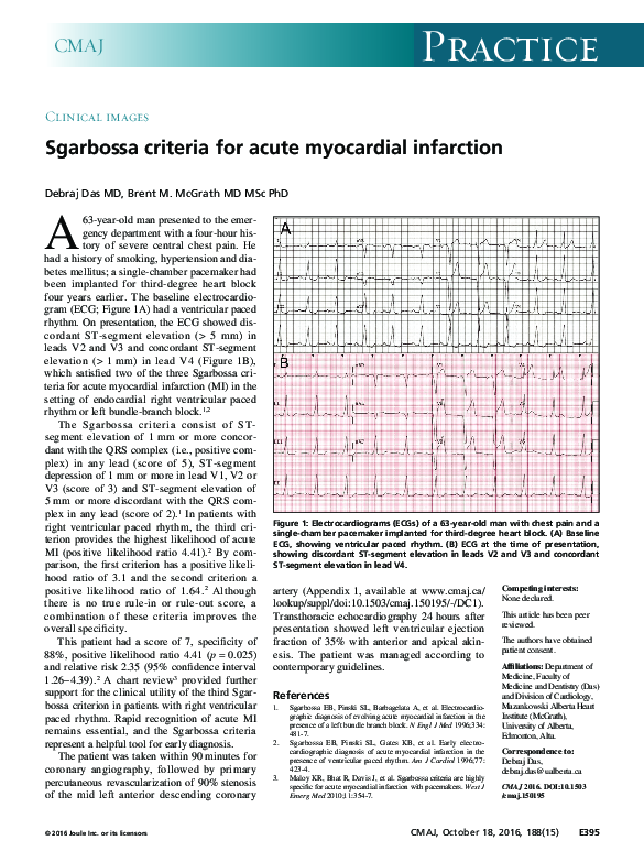 (PDF) Sgarbossa criteria for acute myocardial infarction