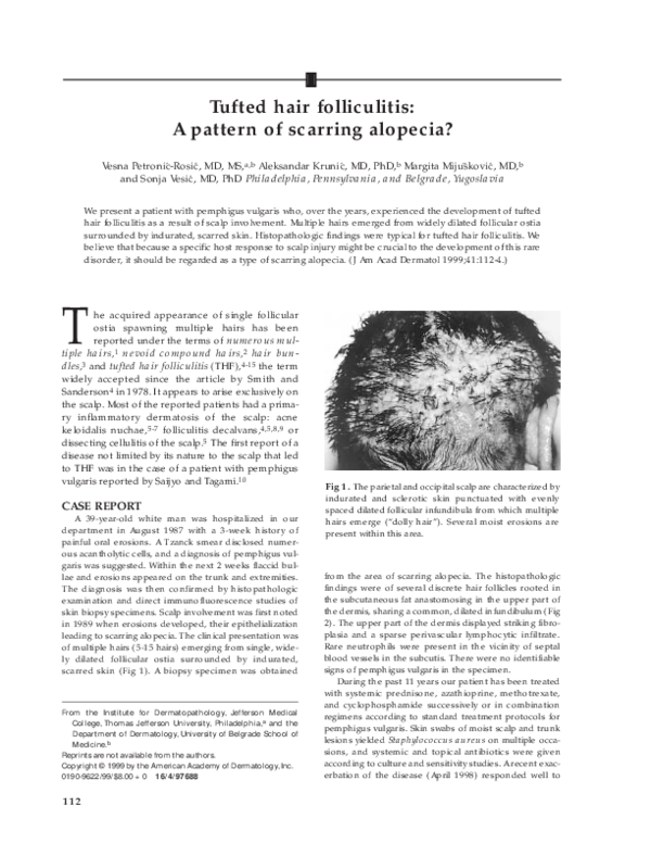 (PDF) Tufted hair folliculitis: A pattern of scarring alopecia?
