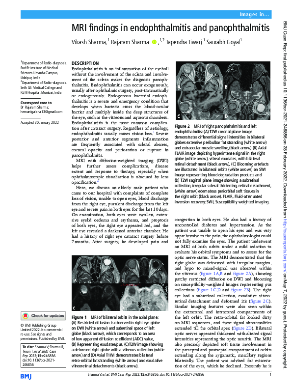 (PDF) MRI findings in endophthalmitis and panophthalmitis
