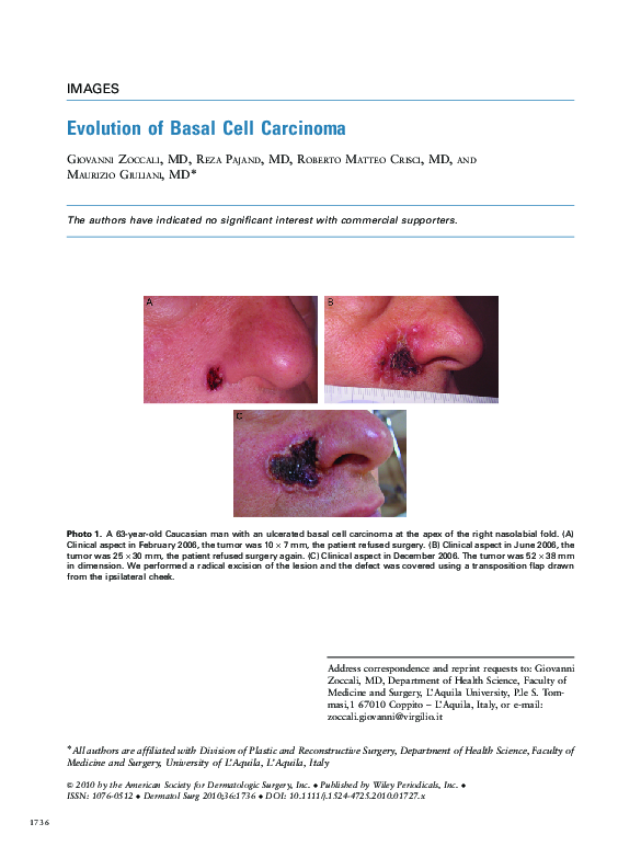 (PDF) Evolution of Basal Cell Carcinoma