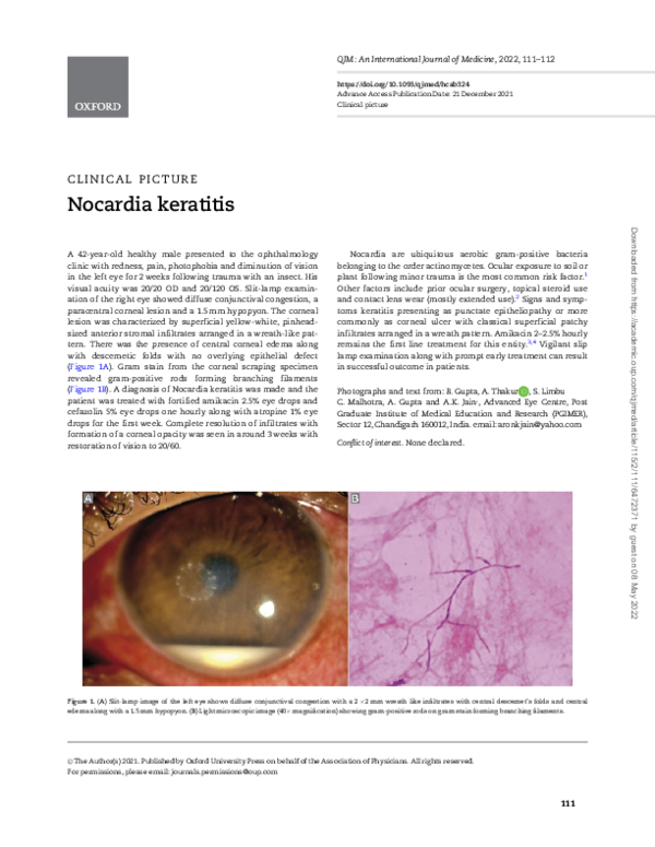 (PDF) Nocardia keratitis | Anchal Thakur - Academia.edu