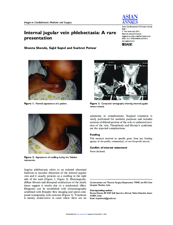 (PDF) Internal jugular vein phlebectasia: A rare presentation