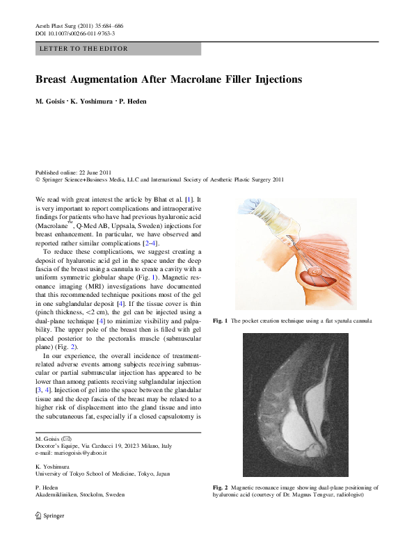 (PDF) Breast Augmentation After Macrolane Filler Injections