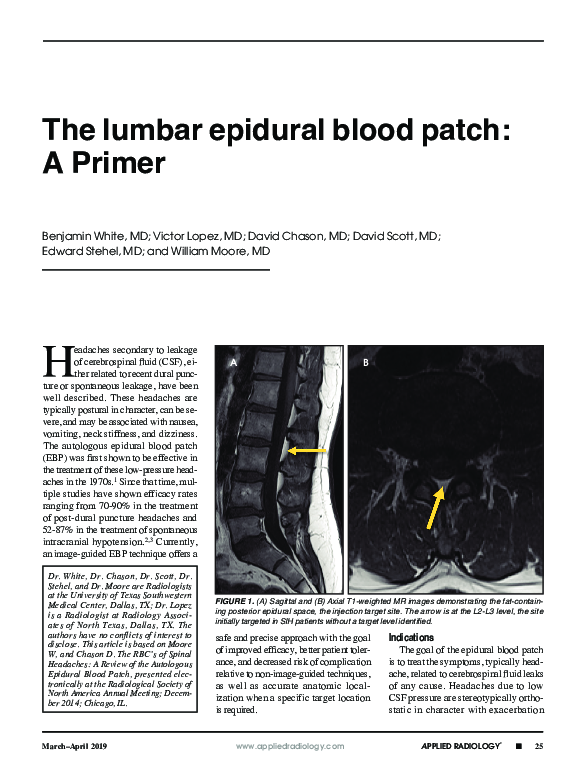 (PDF) The lumbar epidural blood patch: A Primer