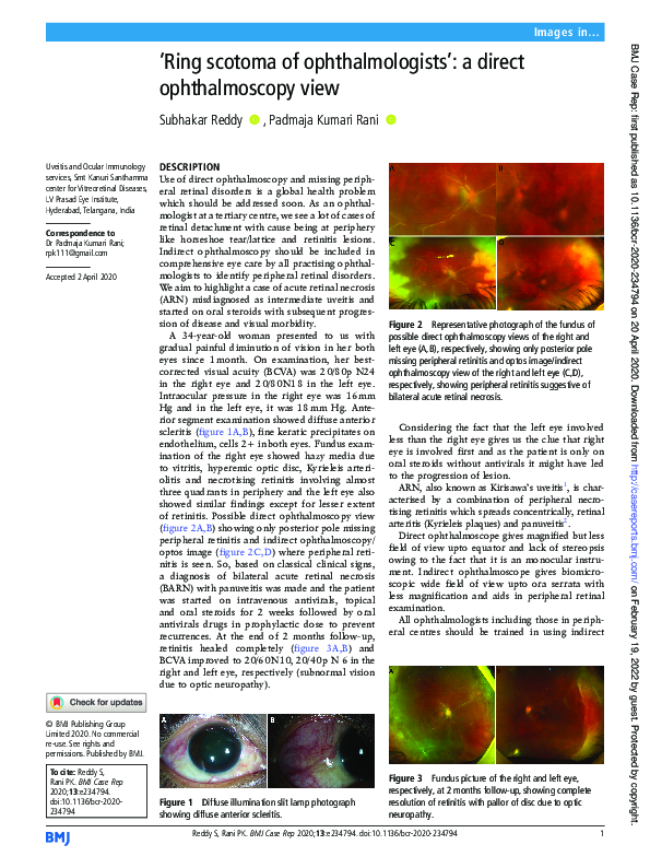 (PDF) ‘Ring scotoma of ophthalmologists’: a direct ophthalmoscopy view