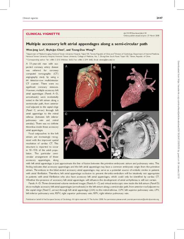 (PDF) Multiple accessory left atrial appendages along a semi-circular ...
