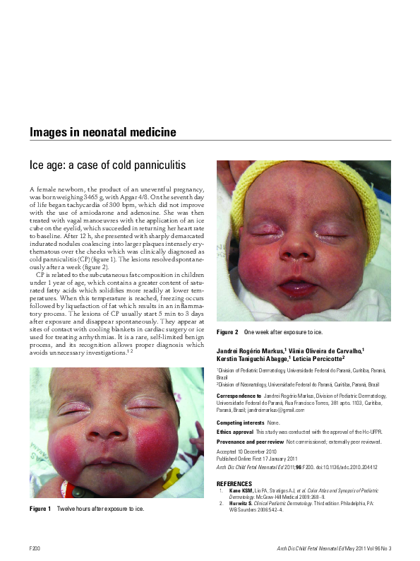 (PDF) Ice age: a case of cold panniculitis