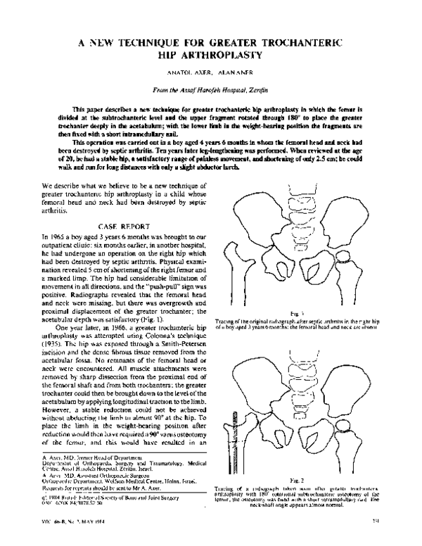 (PDF) A new technique for greater trochanteric hip arthroplasty