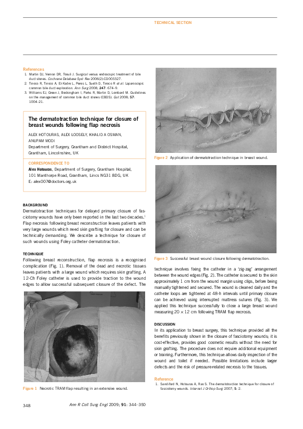 (PDF) The dermatotraction technique for closure of breast wounds ...