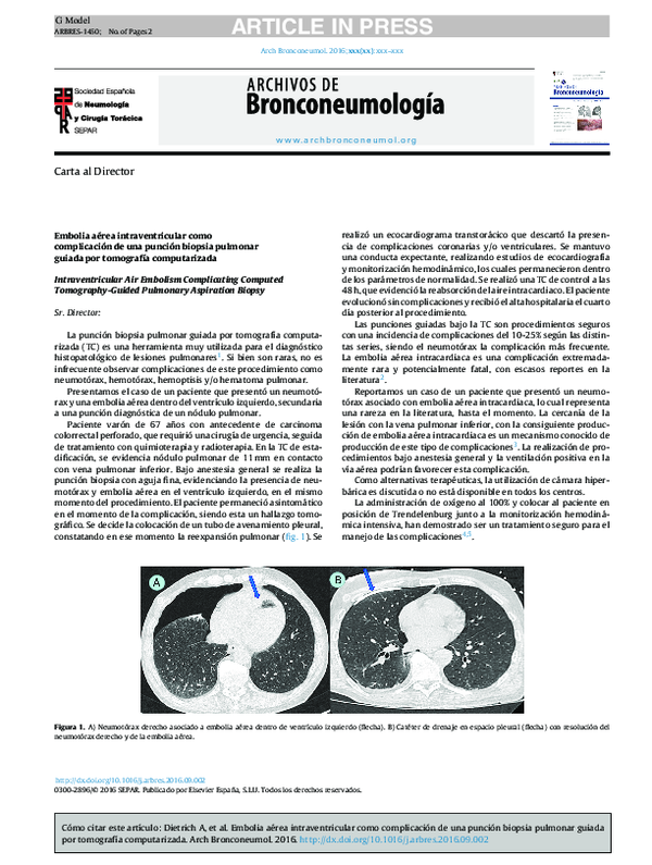(PDF) Embolia aérea intraventricular como complicación de una punción ...