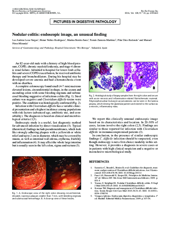 (PDF) Nodular colitis: endoscopic image an unusual finding