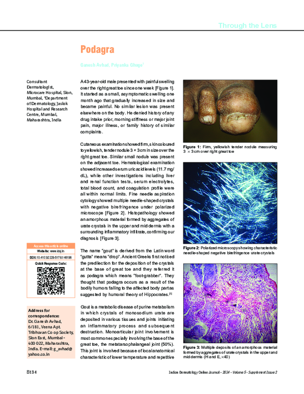 (PDF) Podagra