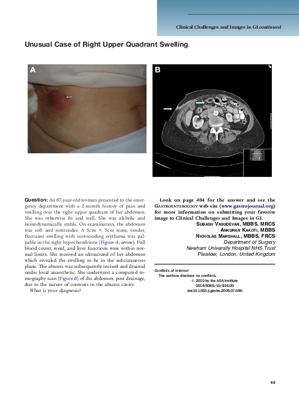 (PDF) Unusual Case of Right Upper Quadrant Swelling