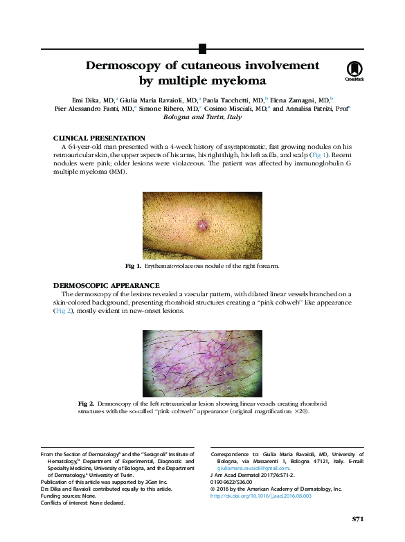 (PDF) Dermoscopy of cutaneous involvement by multiple myeloma
