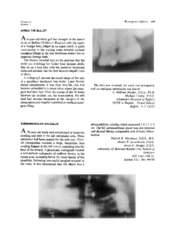 (PDF) Submandibular calculus