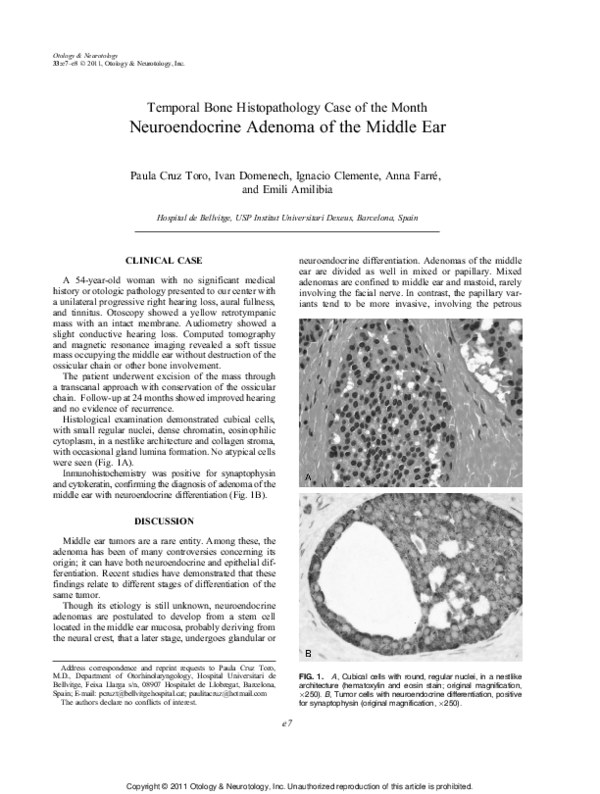 (PDF) Neuroendocrine adenoma of the middle ear | BENJAMIN FERNANDO DIAZ ...