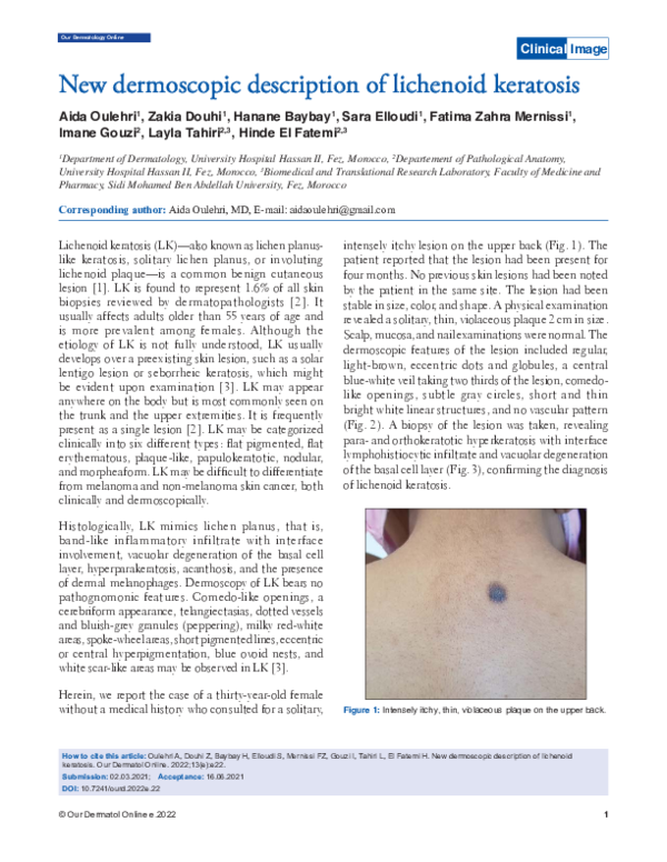 (PDF) New dermoscopic description of lichenoid keratosis