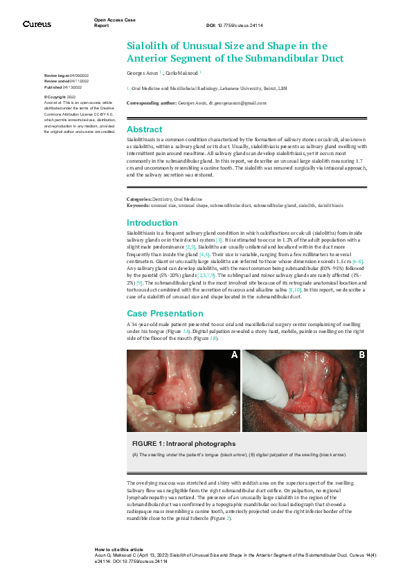(PDF) Sialolith of Unusual Size and Shape in the Anterior Segment of ...