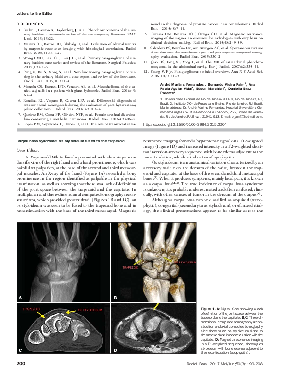 (PDF) Carpal boss syndrome: os styloideum fused to the trapezoid