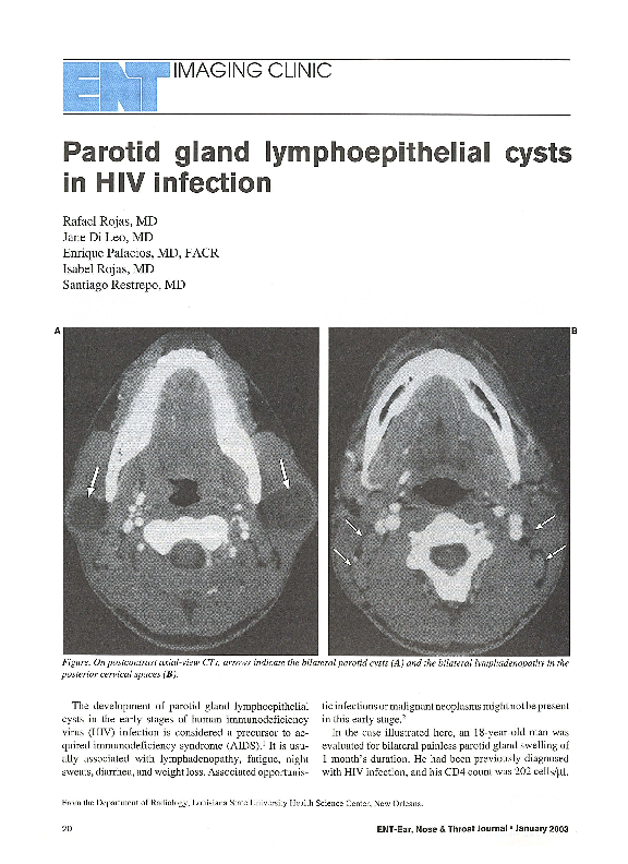 (PDF) Parotid Gland Lymphoepithelial Cysts in HIV Infection