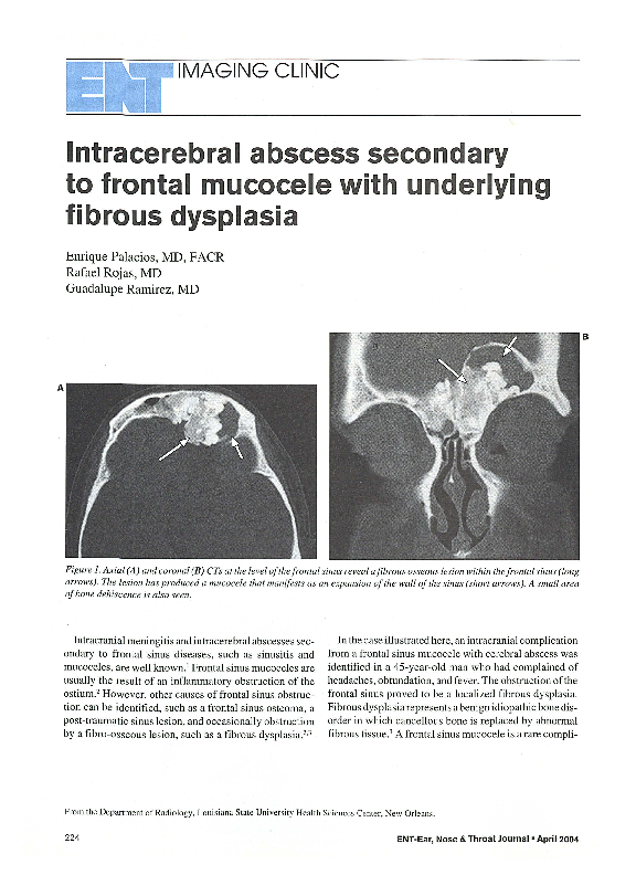 (PDF) Intracerebral Abscess Secondary to Frontal Mucocele with ...