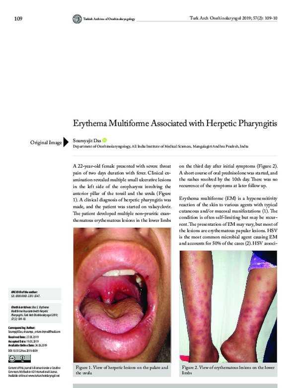 (PDF) Erythema Multiforme Associated with Herpetic Pharyngitis