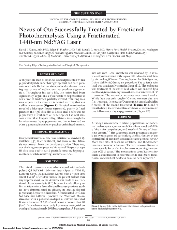 (PDF) Nevus of Ota Successfully Treated by Fractional Photothermolysis ...
