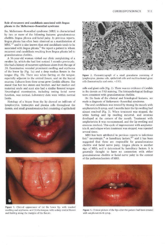 (PDF) Role of recurrent oral candidiasis associated with lingua plicata ...