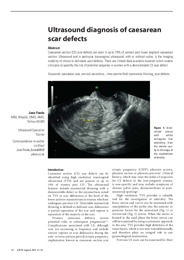 (PDF) Ultrasound diagnosis of caesarean scar defects
