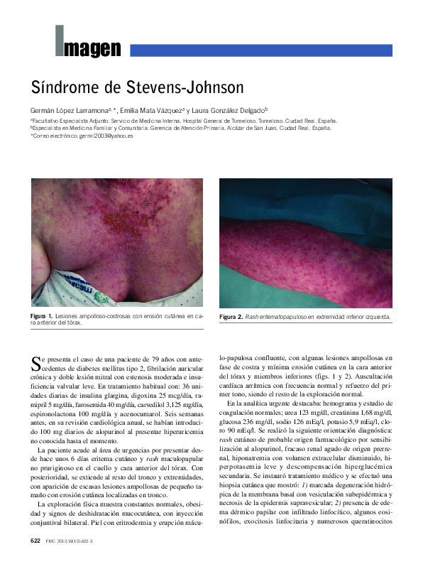 (PDF) Síndrome de Stevens-Johnson
