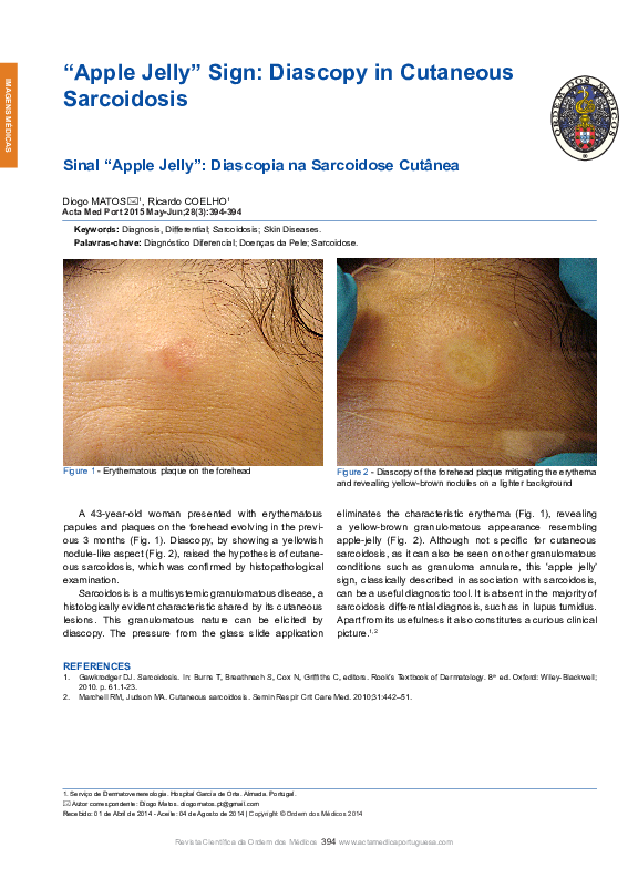 (PDF) “Apple Jelly” Sign: Diascopy in Cutaneous Sarcoidosis | ricardo ...