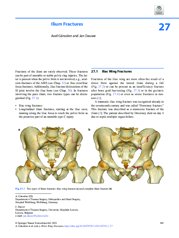 (PDF) Ilium Fractures