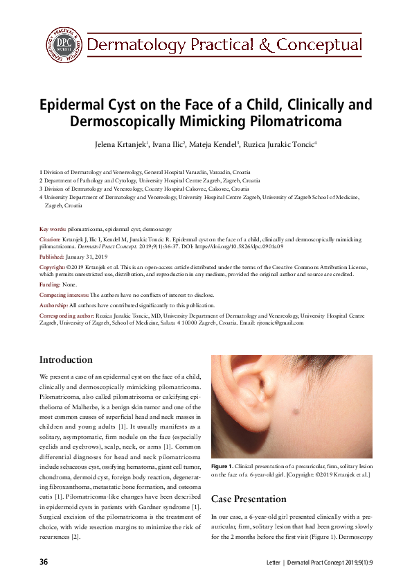 (PDF) Epidermal cyst on the face of a child, clinically and ...