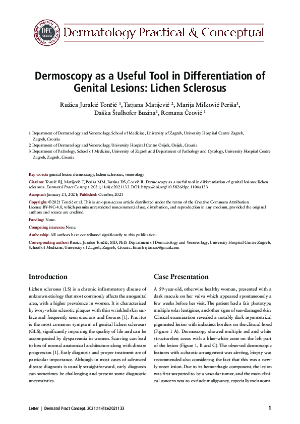 (PDF) Dermoscopy as a Useful Tool in Differentiation of Genital Lesions: Lichen Sclerosus