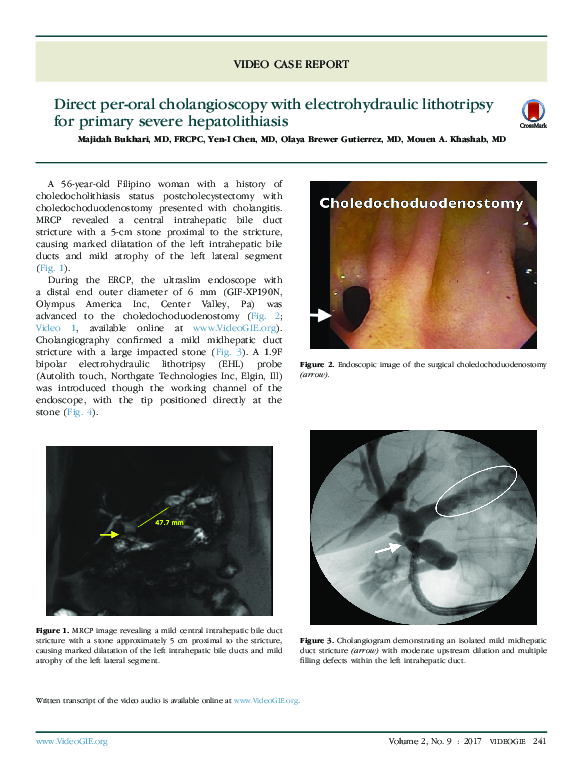 (PDF) Direct per-oral cholangioscopy with electrohydraulic lithotripsy ...