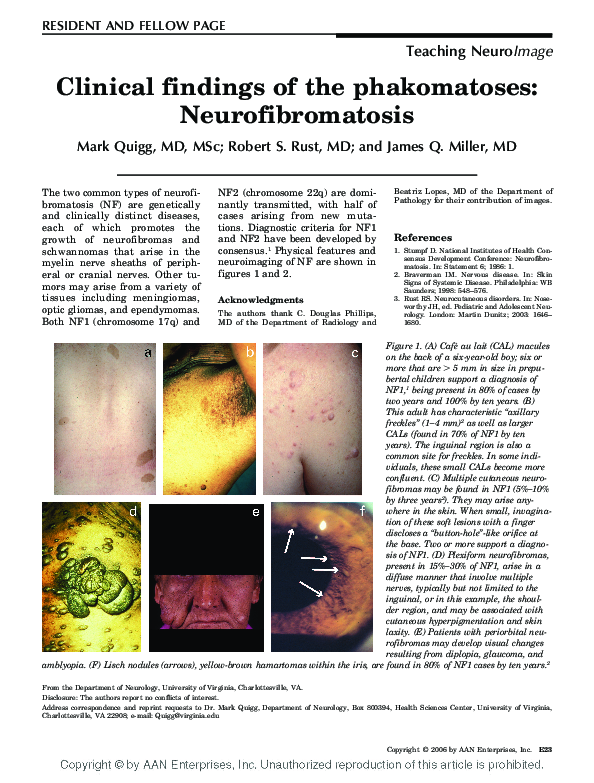 (PDF) Clinical findings of the phakomatoses: Neurofibromatosis
