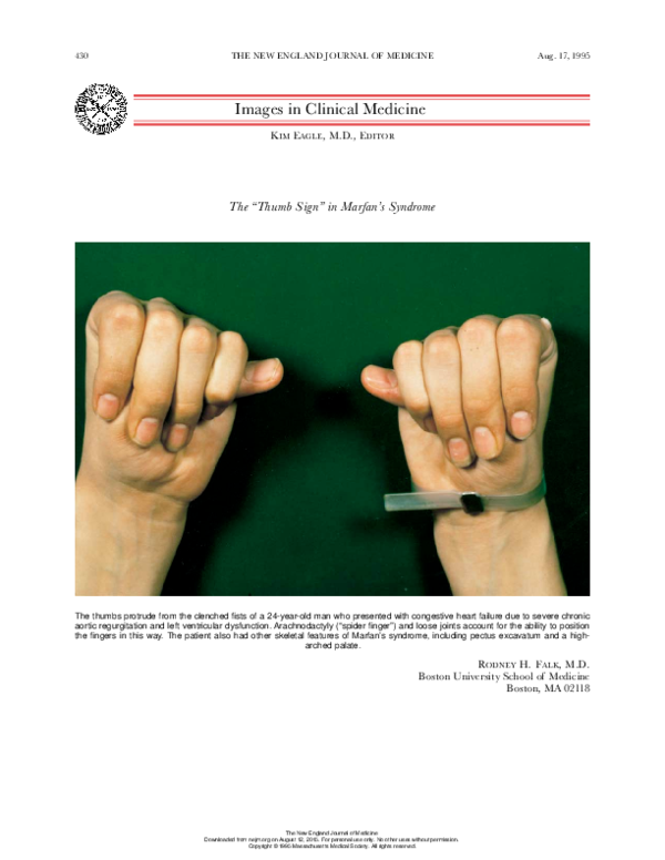(PDF) The “Thumb Sign” in Marfan's Syndrome