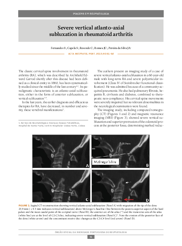 (PDF) Severe Atlanto-Axial Subluxation in Rheumatoid Arthritis Case