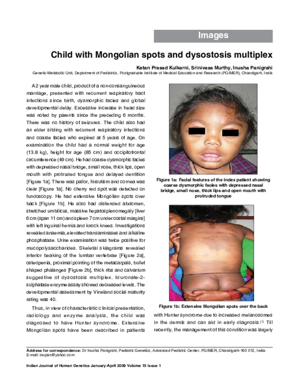 (PDF) Child with Mongolian spots and dysostosis multiplex | SRINIVASA ...