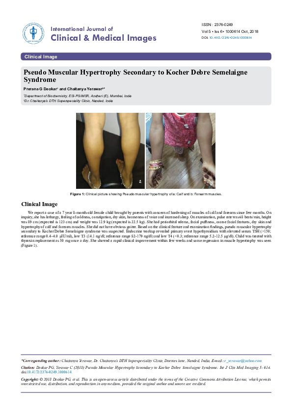 (PDF) Pseudo Muscular Hypertrophy Secondary to Kocher Debre Semelaigne ...