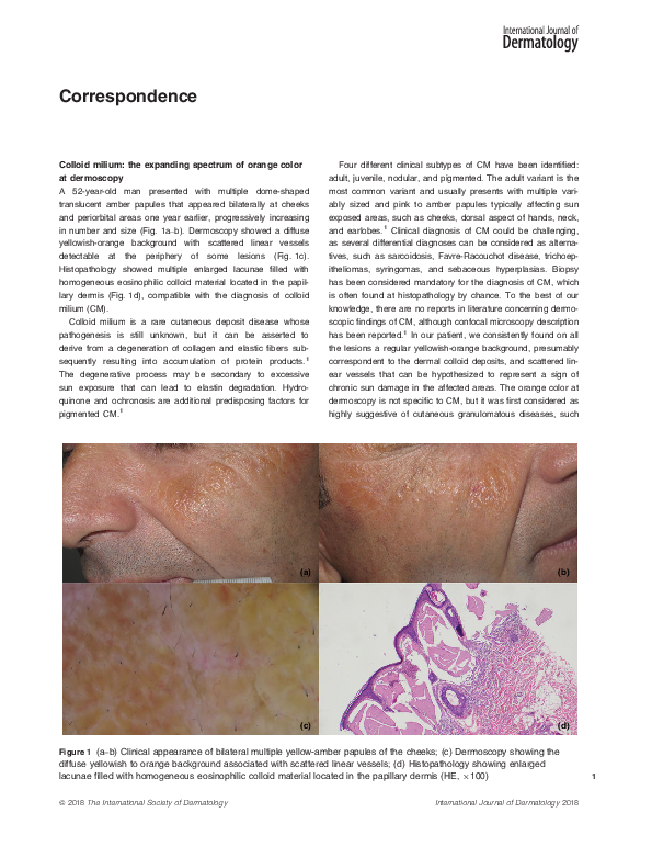 (PDF) Colloid milium: the expanding spectrum of orange color at ...
