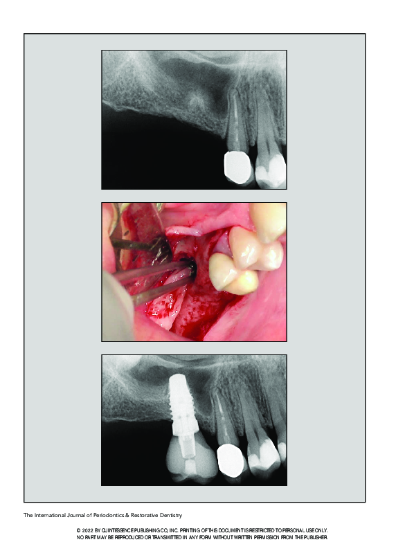 (PDF) Lateral Sinus Floor Elevation in the Severely Atrophied Maxilla: Concentrated Growth ...