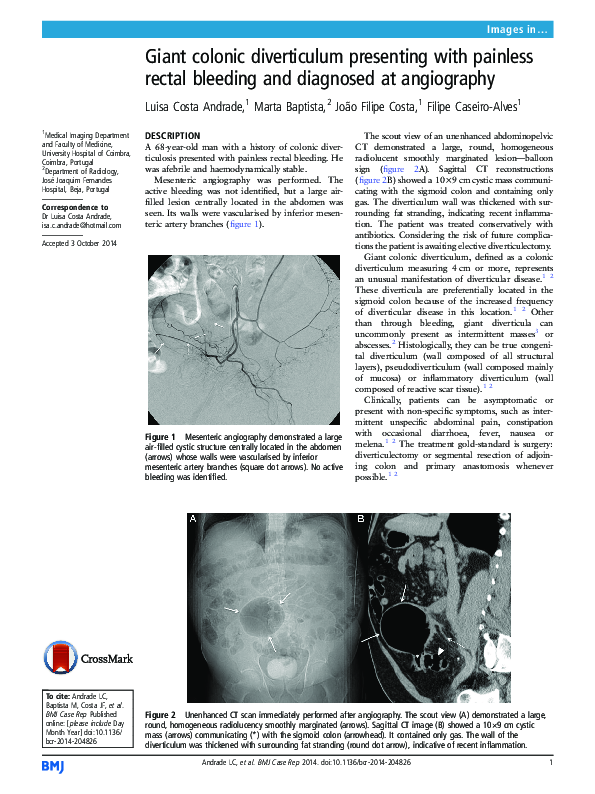 (PDF) Giant colonic diverticulum presenting with painless rectal ...