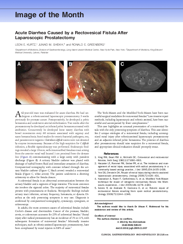 (PDF) Acute Diarrhea Caused by a Rectovesical Fistula After ...